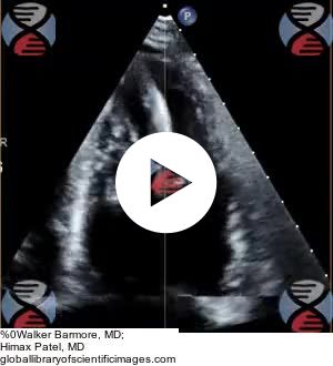 Short axis view of Right Ventricular AICD Lead | Global Library of ...