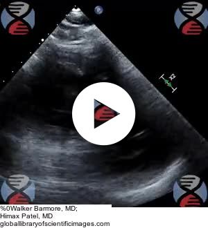 Apical view of Right Ventricular AICD Lead | Global Library of ...