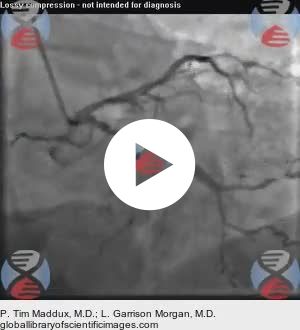 Severe Left Circumflex Stenosis with Stent Placement in the Proximal ...