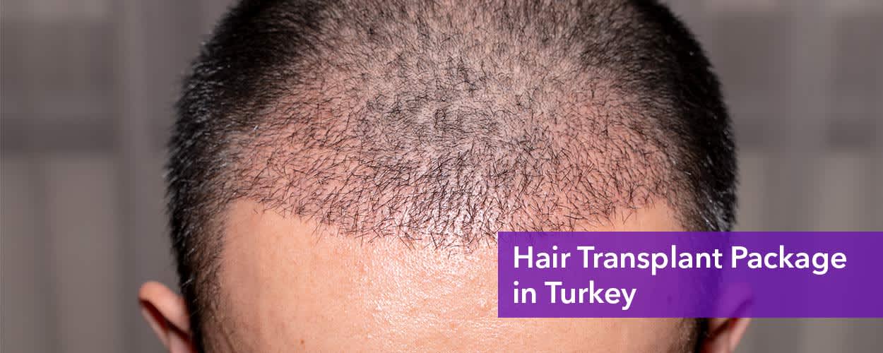 Hair Transplant In Turkey Top Best Hair Transplant In Turkey