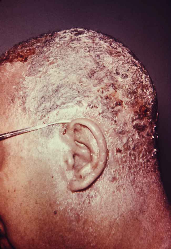 Dermatitis Seboroik - Patofisiologi, diagnosis, penatalaksanaan - Alomedika