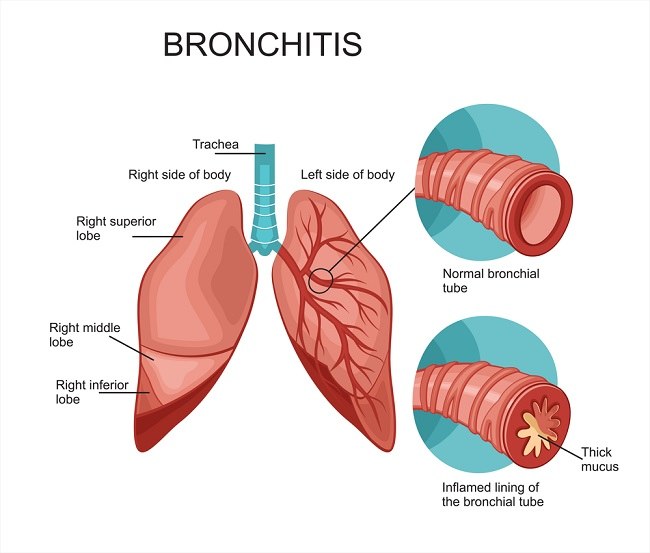 Diagnosis Bronkitis Akut Alomedika
