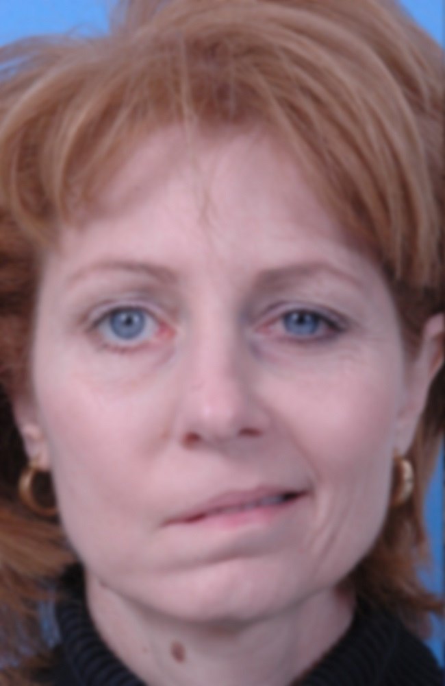 Transient Ischemic Attack (TIA) - patofisiologi, diagnosis ...