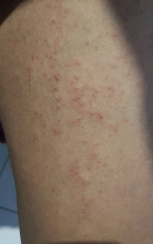 Tigdas Hangin Treatment For Adults