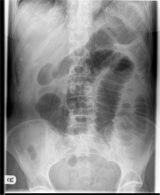 Ileus Obstruktif - patofisiologi, diagnosis, penatalaksanaan - Alomedika