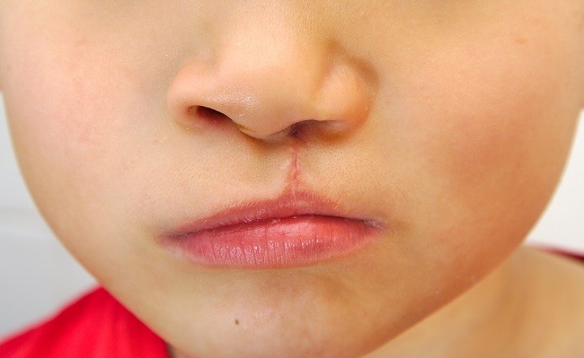 Operasi Bibir Sumbing, Ini yang Perlu Anda Ketahui - Alodokter Operasi Bibir Sumbing, Ini yang Perlu Anda Ketahui - Alodokter