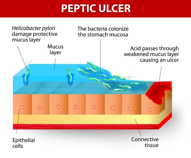 Ulkus Peptikum - patofisiologi, diagnosis, penatalaksanaan - Alomedika
