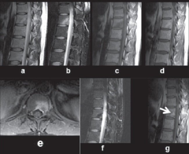 Spondilitis TB - patofisiologi, diagnosis, penatalaksanaan - Alomedika