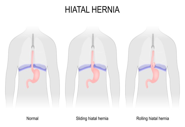 Diagnosis Hernia Hiatus - Alomedika