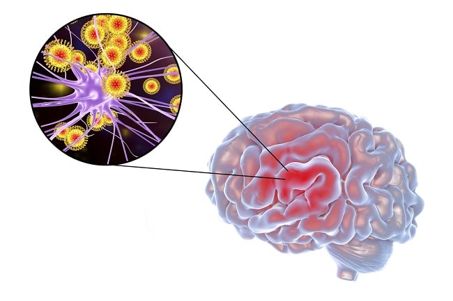 Ensefalitis - patofisiologi, diagnosis, penatalaksanaan - Alomedika