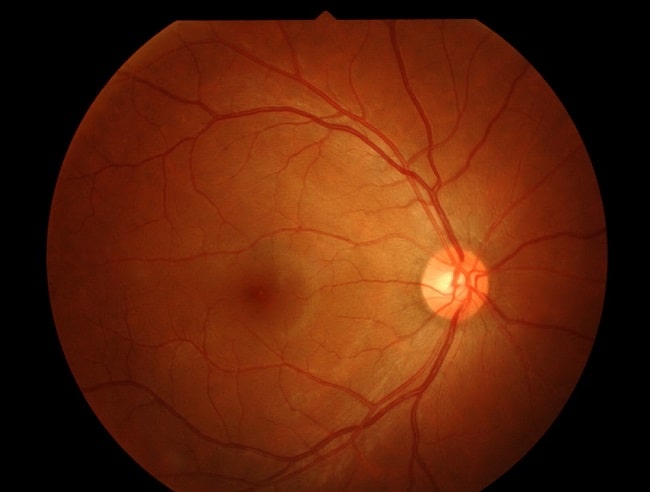 Diagnosis Oklusi Arteri Retina Sentral - Alomedika