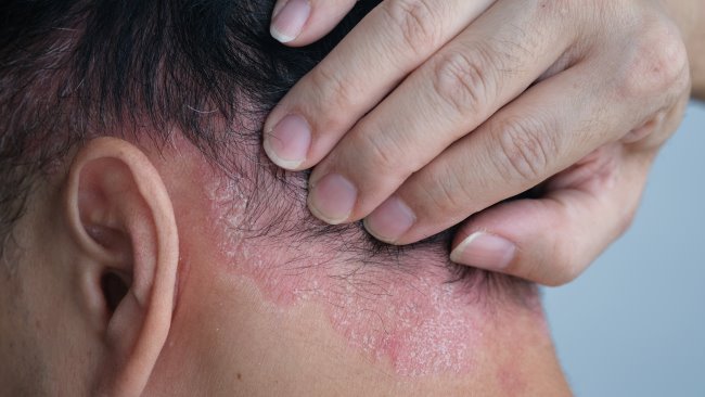 Dermatitis Seboroik - Gejala, Penyebab, dan Pengobatan - Alodokter