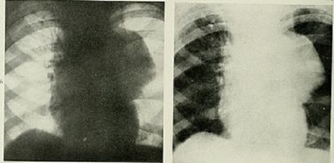 Pelebaran Mediastinum pada Rontgen Thorax Pasien Dewasa - Alomedika