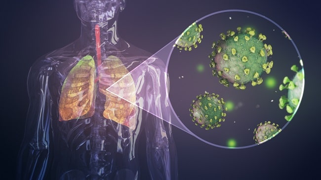Severe Acute Respiratory Syndrome (SARS) - patofisiologi, diagnosis ...