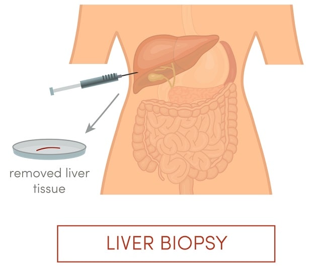 Teknik Biopsi Hepar - Alomedika
