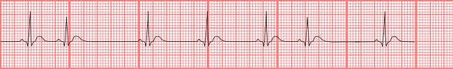 Supraventricular Extrasystole - patofisiologi, diagnosis ...