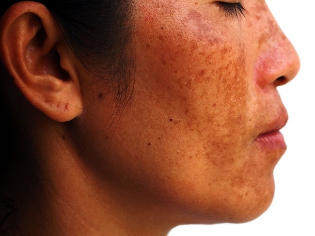 Melasma - patofisiologi, diagnosis, penatalaksanaan - Alomedika