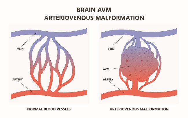 Malformasi Arteri Vena - Gejala, penyebab dan mengobati - Alodokter
