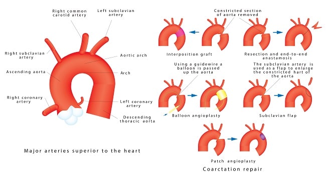 Koarktasio Aorta - patofisiologi, diagnosis, penatalaksanaan - Alomedika