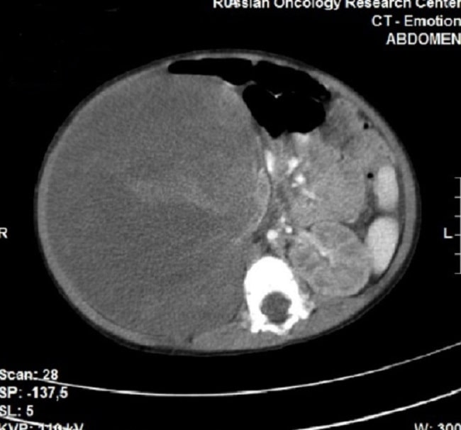 Prognosis Wilms Tumor (Nefroblastoma) - Alomedika