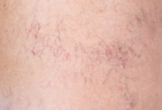 Telangiektasis - Gejala, penyebab dan mengobati - Alodokter