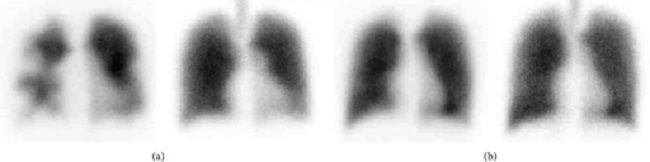 Ventilation/Perfusion Lung Scan - patofisiologi, diagnosis ...