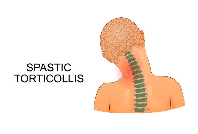 Diagnosis Tortikolis - Alomedika