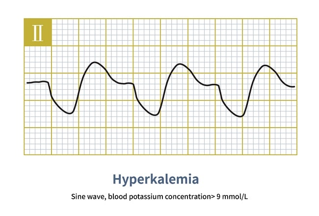 Diagnosis Hiperkalemia - Alomedika