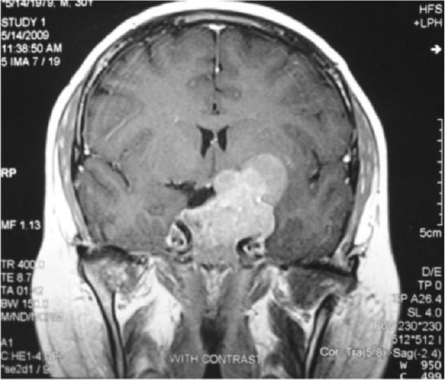 Diagnosis Prolaktinoma - Alomedika