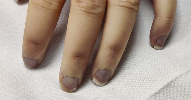 Diagnosis Syok Sepsis - Alomedika