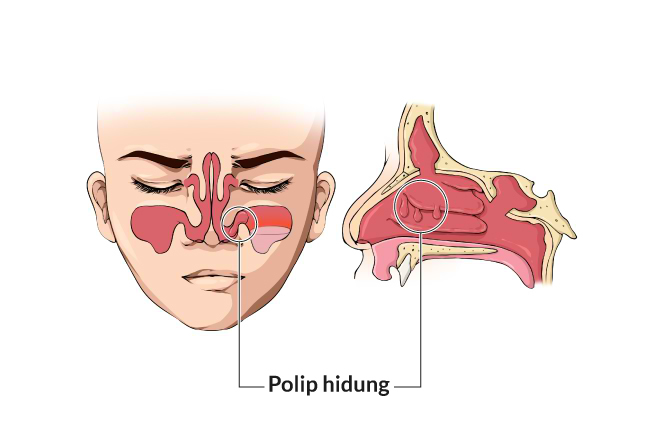 Gejala Polip Hidung - Alodokter