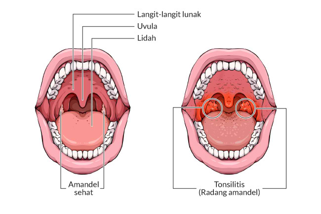 Gejala Radang Amandel - Alodokter
