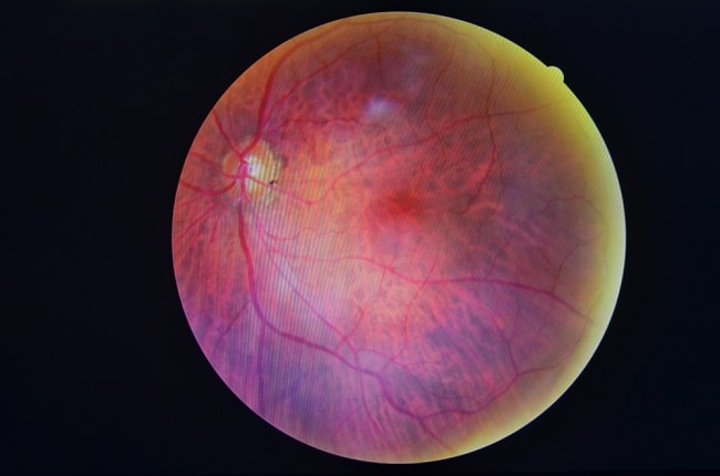 Retinopati Diabetik - patofisiologi, diagnosis, penatalaksanaan - Alomedika
