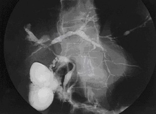 Apakah Kolangiografi Intraoperatif Rutin Diperlukan pada Laparoskopi ... Apakah Kolangiografi Intraoperatif Rutin Diperlukan pada Laparoskopi ...