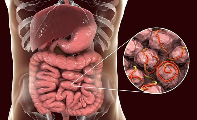 Enterobiasis - patofisiologi, diagnosis, penatalaksanaan - Alomedika