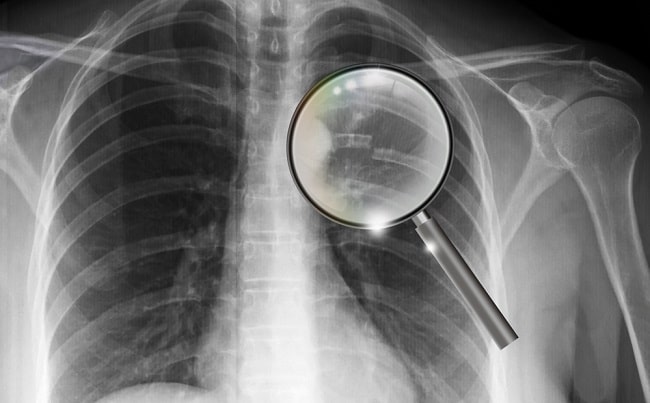 Fraktur Tulang Rusuk - patofisiologi, diagnosis, penatalaksanaan ...