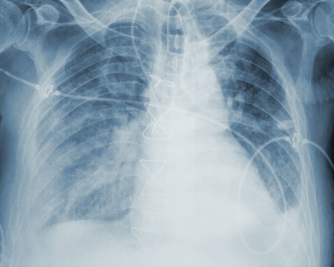 Pneumonia Nosokomial - patofisiologi, diagnosis, penatalaksanaan - Alomedika