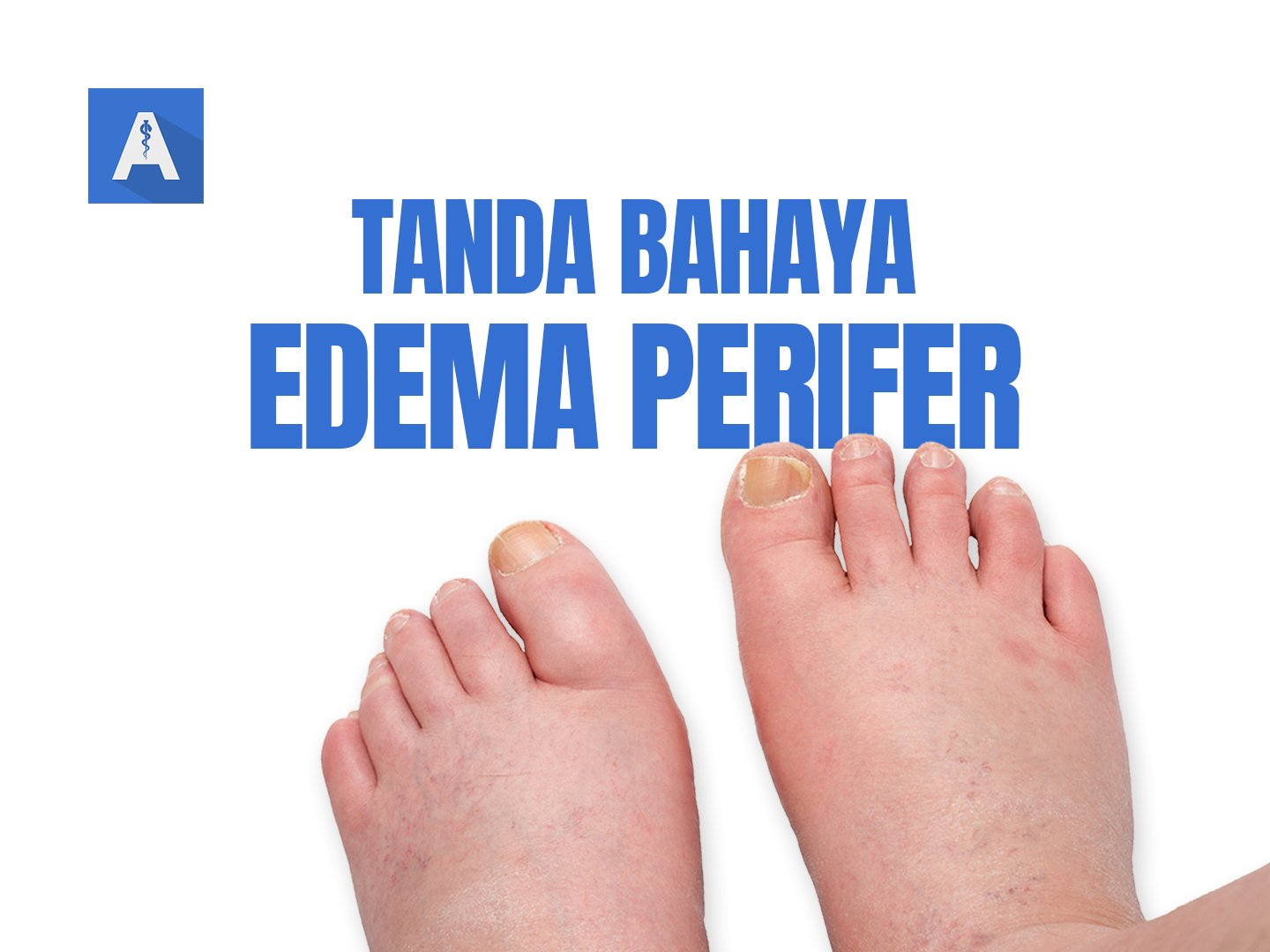Video Alomedika - Red Flags Edema Perifer - Alomedika