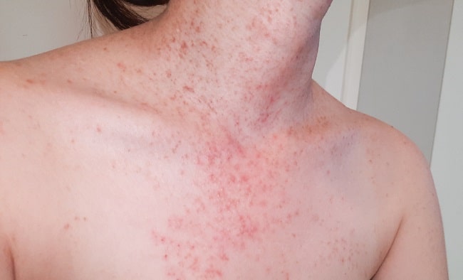 Diagnosis Folikulitis Malassezia (Fungal Acne) - Alomedika