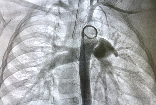 Diagnosis Patent Ductus Arteriosus Alomedika