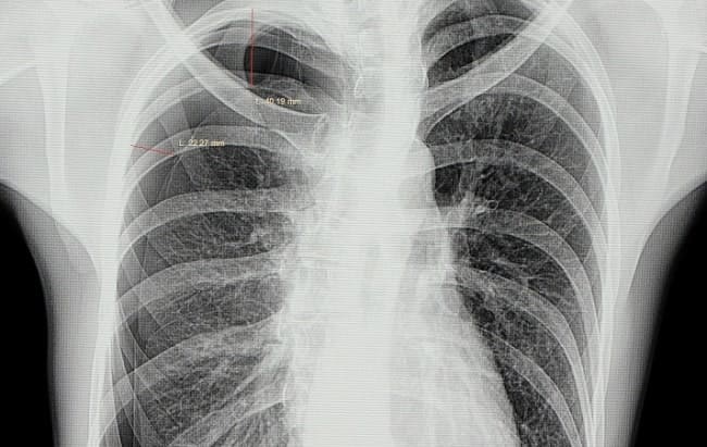 Chest Tube Bukan Terapi Lini Pertama pada Pneumotoraks Spontan Primer ...