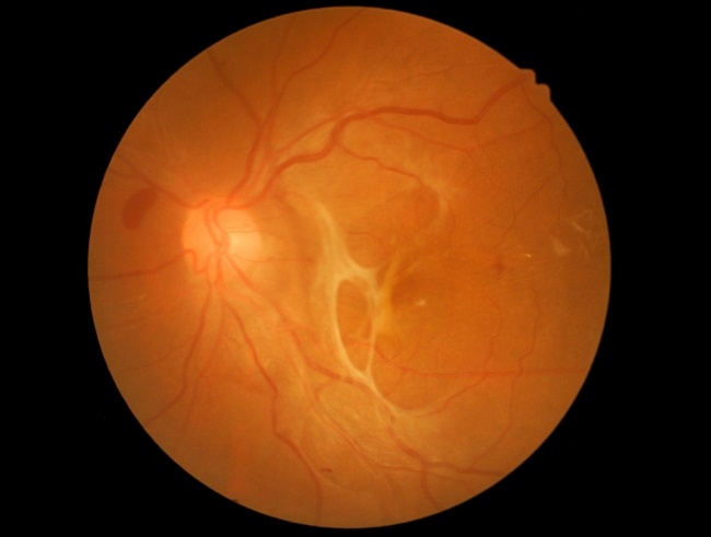 Diagnosis Ablatio Retina - Alomedika