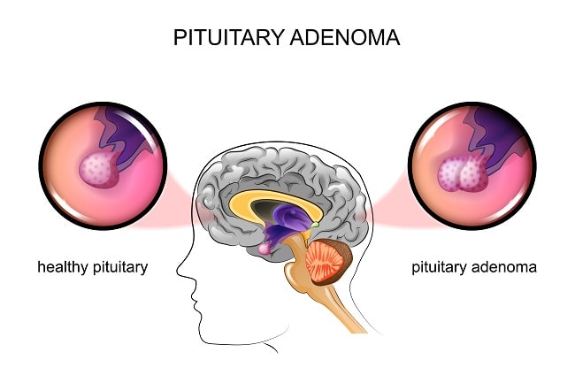 Diagnosis Tumor Pituitari - Alomedika