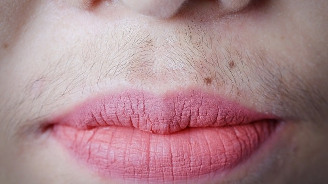 Hirsutism - patofisiologi, diagnosis, penatalaksanaan - Alomedika