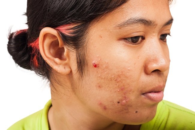 Gel Dapsone untuk Terapi Acne Vulgaris - Alomedika