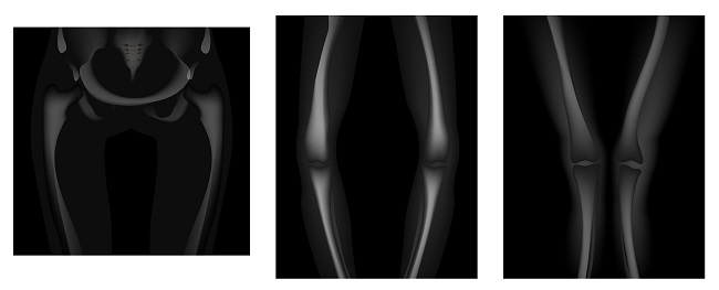 Rakitis - patofisiologi, diagnosis, penatalaksanaan - Alomedika