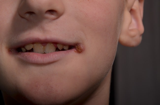 Diagnosis Cheilitis - Alomedika