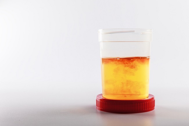 Red Flag Hematuria - Alomedika