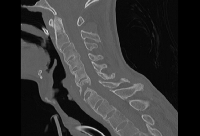 Spondilolisis - patofisiologi, diagnosis, penatalaksanaan - Alomedika