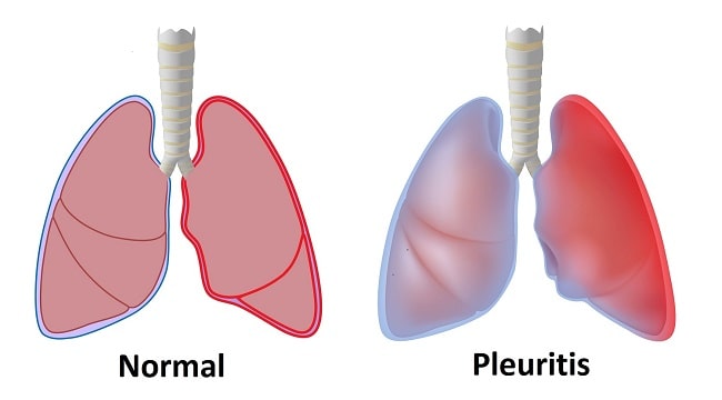 Patofisiologi Pleuritis - Alomedika